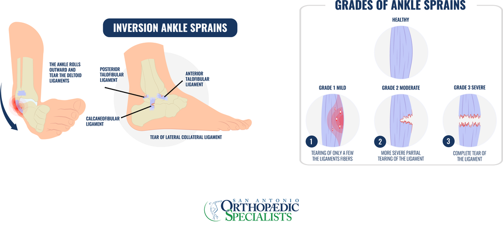 Understanding Sprains vs. Broken Bones: Key Differences — San Antonio ...