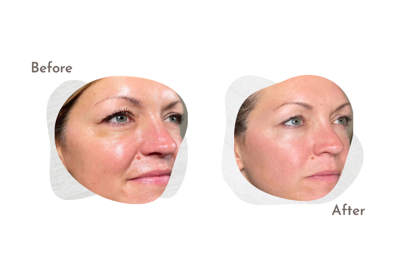 TriLift Columbus Ohio | Non-surgical facelift | Stratus Plastic Surgery