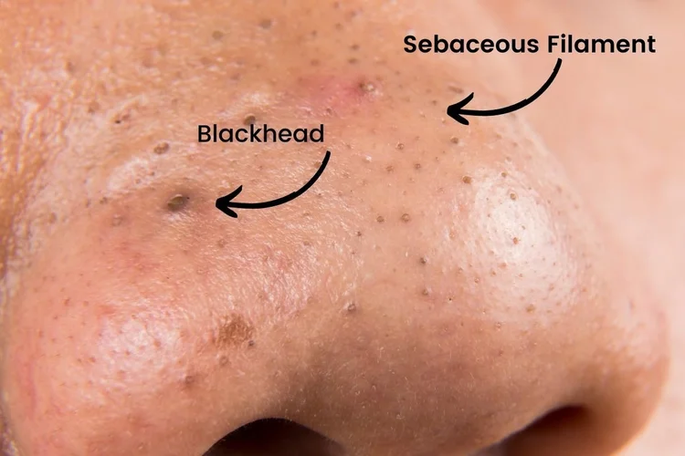 What are blackheads? Facts and The Best Treatments — Soma Wellness Spa