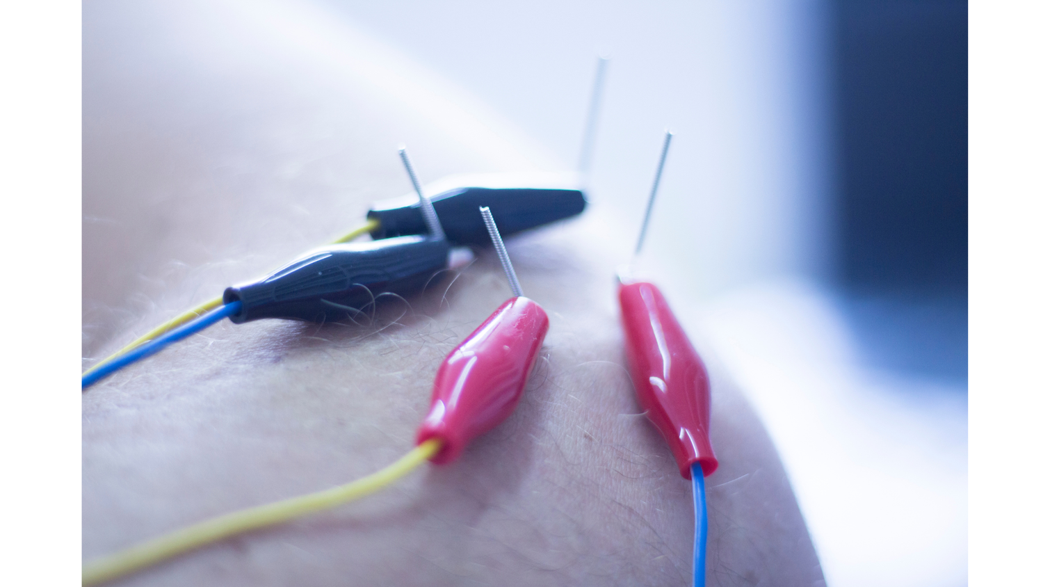 Dry Needling for Rotator Cuff Injury: A Breakthrough in Shoulder Pain ...