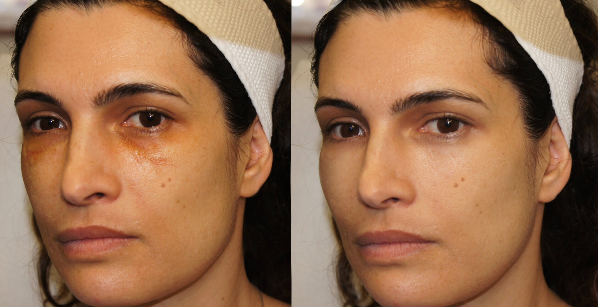 CO2 Laser | Stuart, FL | Neurostrive Hydration and Medspa