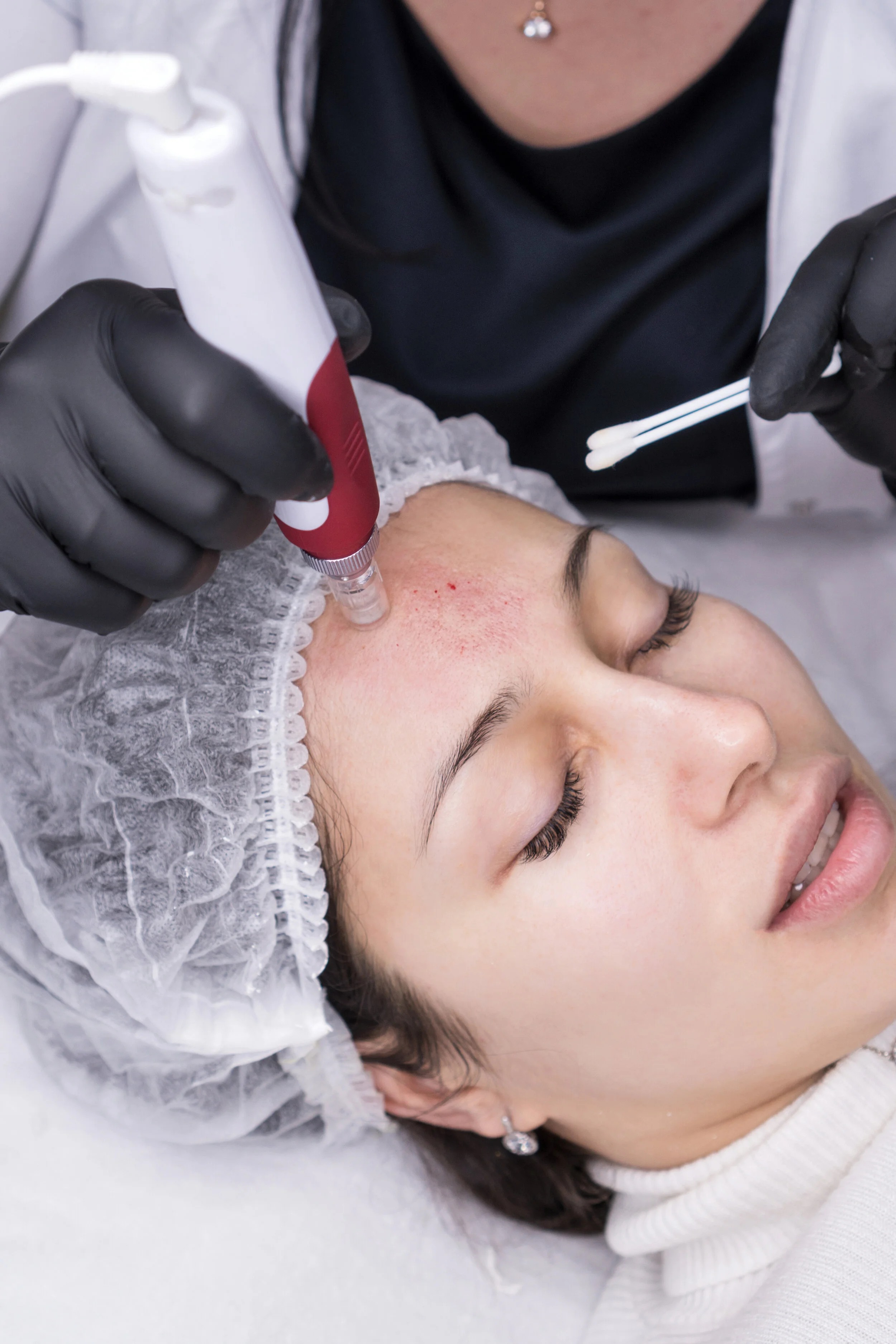 Microneedling + PRP | Stuart, FL | Neurostrive Hydration and Medspa