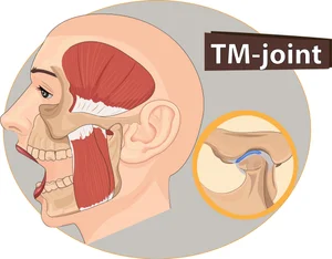 Dry Needling for TMJ — Morningside Acupuncture NYC