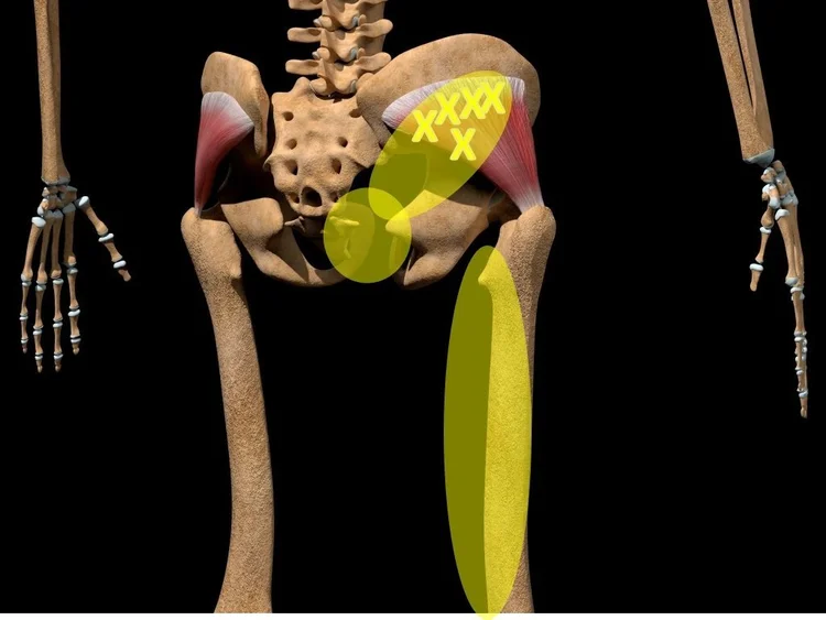 Acupuncture For Gluteus Minimus Trigger Points — Morningside