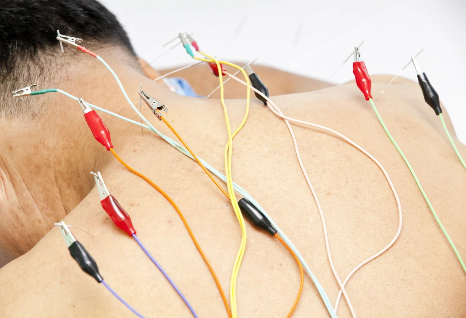 Comparing Dry Needling vs Electroacupuncture — Morningside Acupuncture NYC