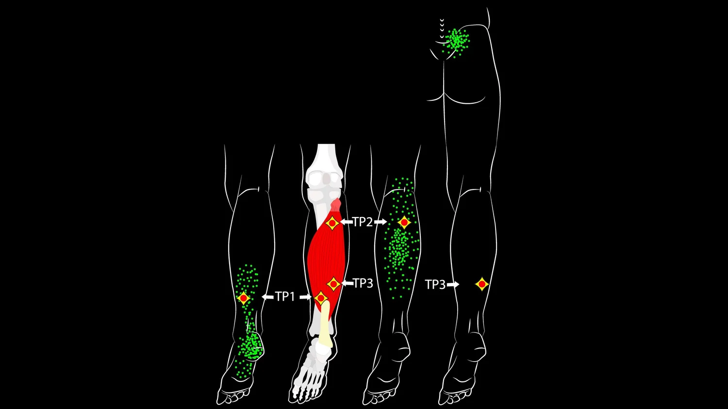 Soleus Strain Treatment — Morningside Acupuncture NYC