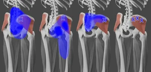 Gluteus Medius Trigger Points — Morningside Acupuncture NYC