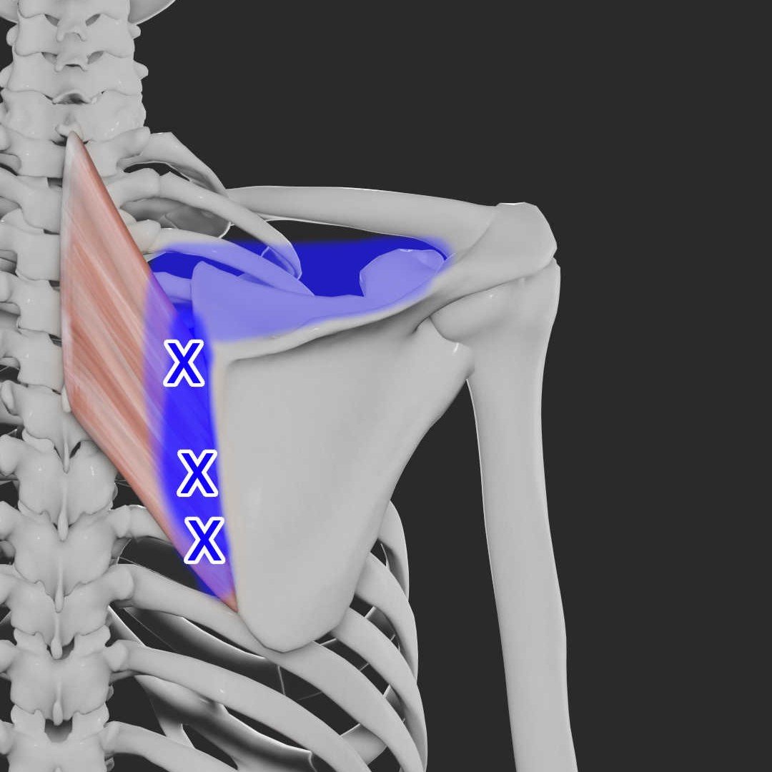 Rhomboid Major and Minor Trigger Points — Morningside Acupuncture NYC