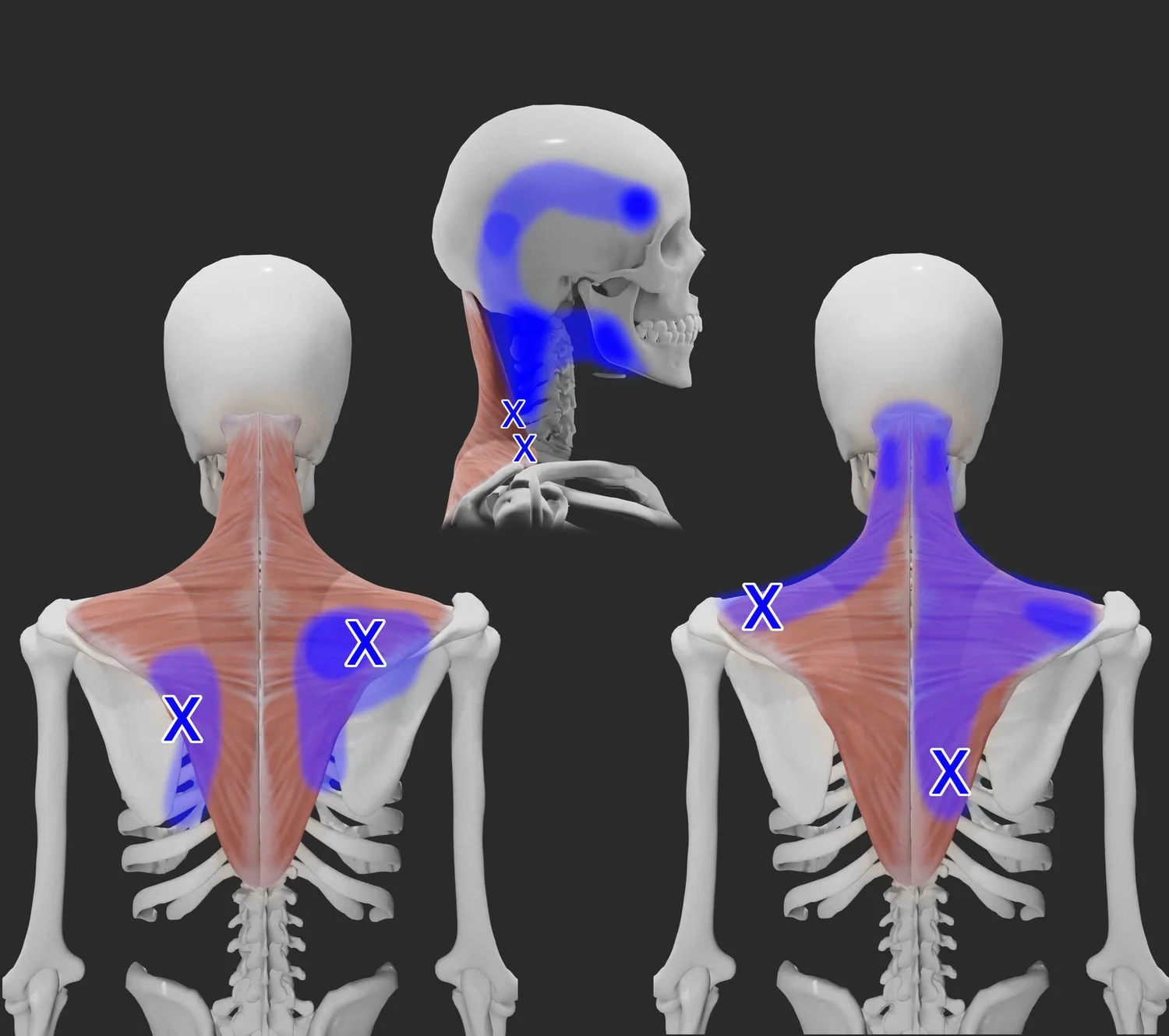 Trapezius Trigger Points — Morningside Acupuncture NYC