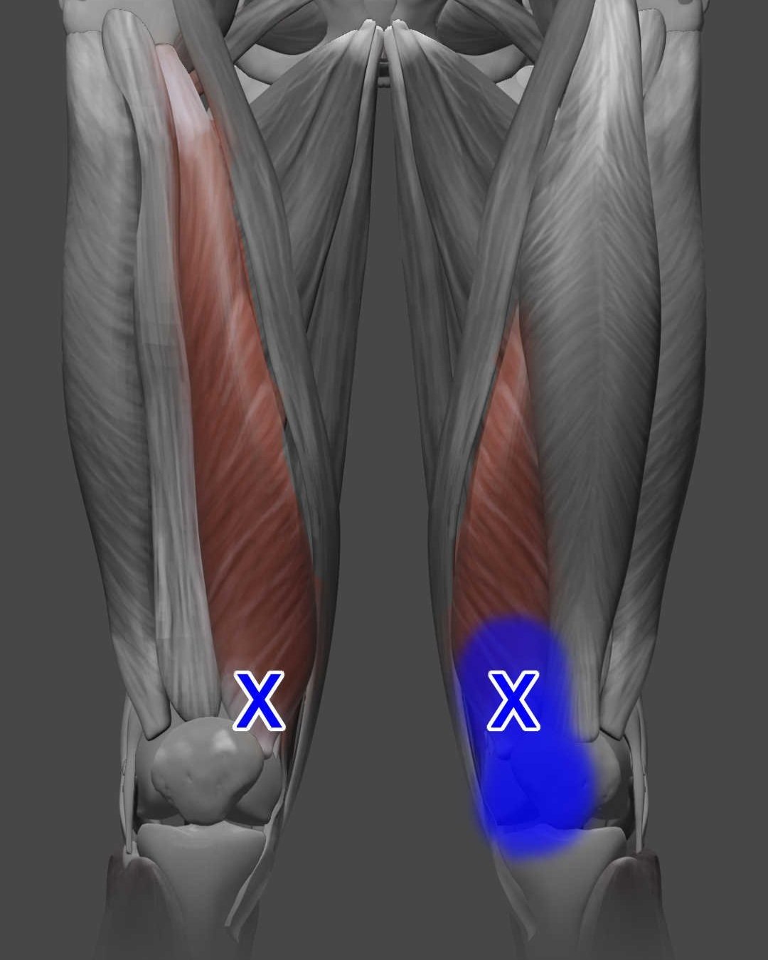 Vastus Medialis Trigger Points — Morningside Acupuncture NYC