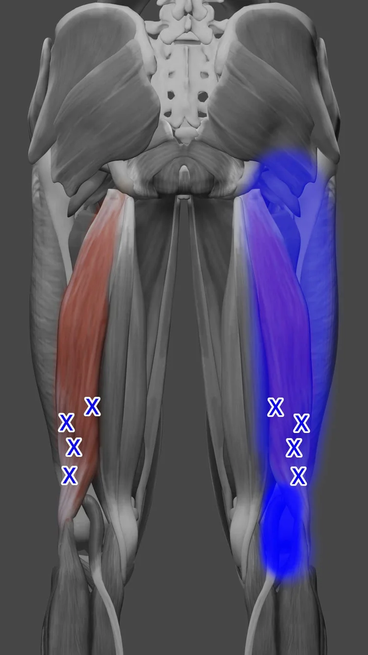 Biceps Femoris Trigger Points — Morningside Acupuncture NYC