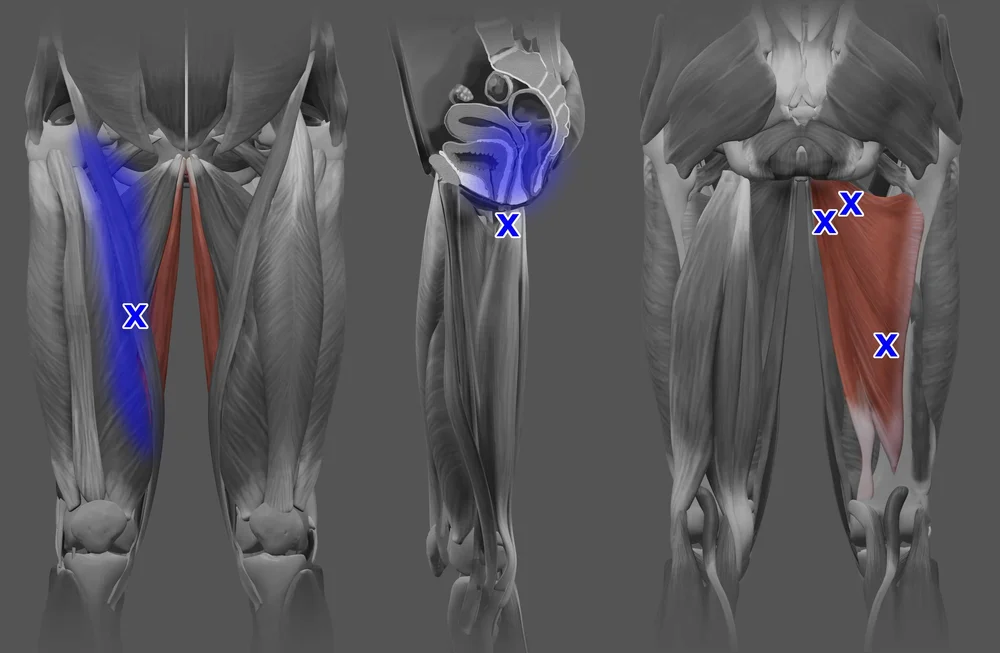 Adductor Magnus Trigger Points — Morningside Acupuncture NYC