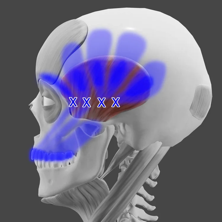 Temporalis Trigger Points — Morningside Acupuncture NYC