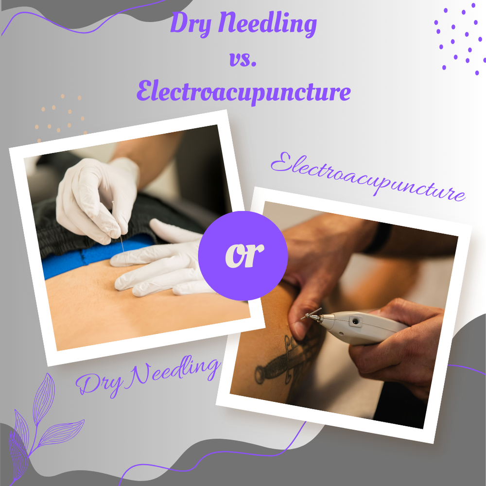Comparing Dry Needling vs Electroacupuncture — Morningside Acupuncture NYC