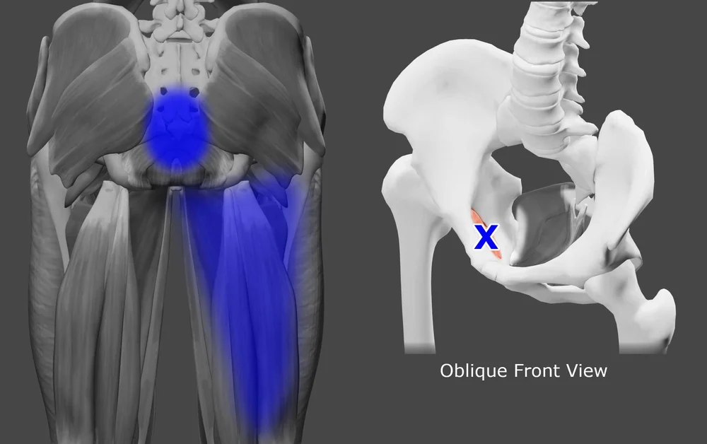 Obturator Internus Trigger Points — Morningside Acupuncture NYC