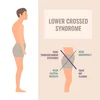 What is Lower Cross Syndrome? — Morningside Acupuncture NYC