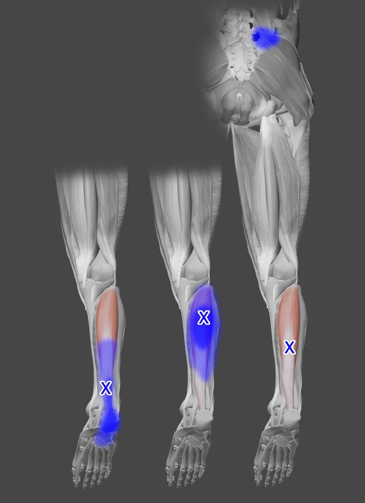 Soleus Trigger Points — Morningside Acupuncture NYC