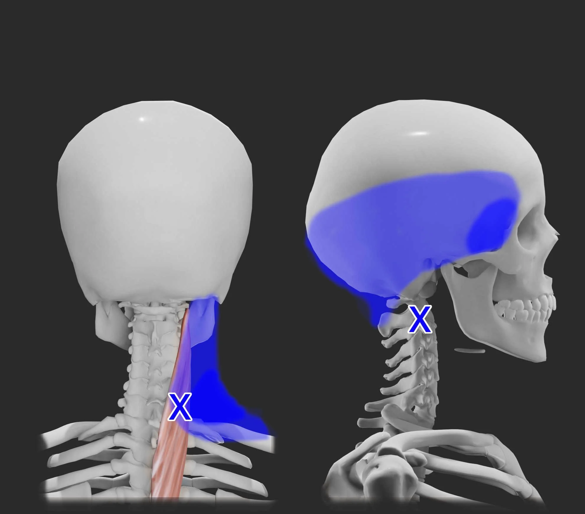 Splenius Cervicis Trigger Points — Morningside Acupuncture NYC