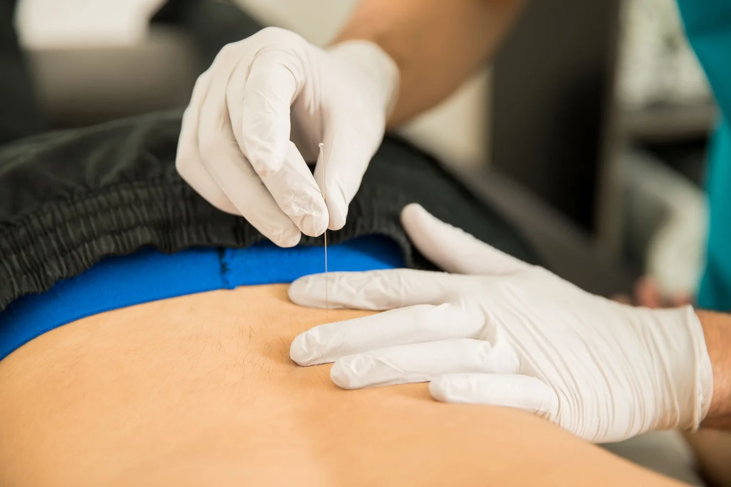 Understanding the Research: Dry Needling for Low Back Pain ...