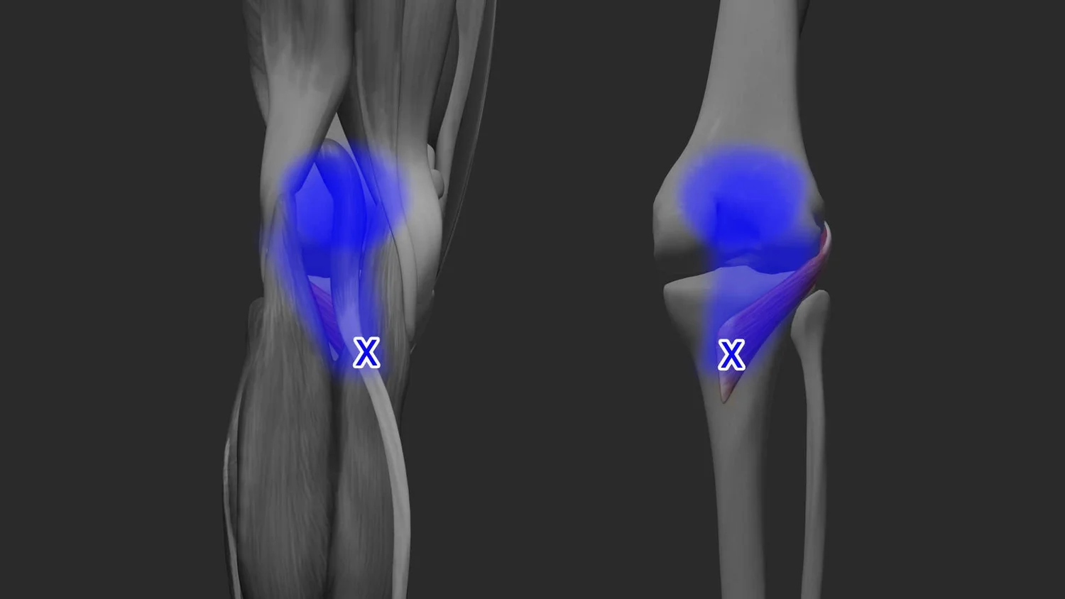 Acupuncture for Popliteus Muscle Pain — Morningside Acupuncture NYC