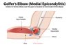 Golfers Elbow Treatment NYC — Morningside Acupuncture NYC