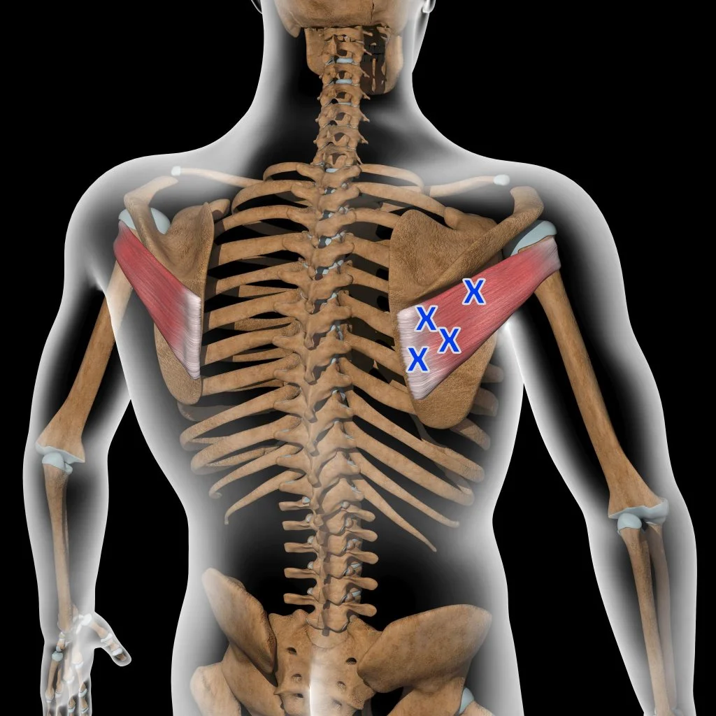 Acupuncture for Infraspinatus Trigger Points — Morningside Acupuncture NYC