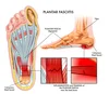 Dry Needling for Plantar Fasciitis — Morningside Acupuncture NYC
