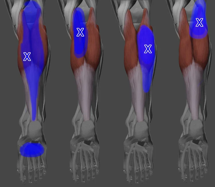 Gastrocnemius Trigger Points — Morningside Acupuncture NYC