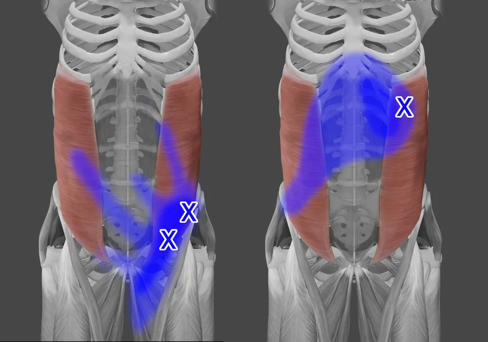 Abdominal Obliques Trigger Points — Morningside Acupuncture NYC
