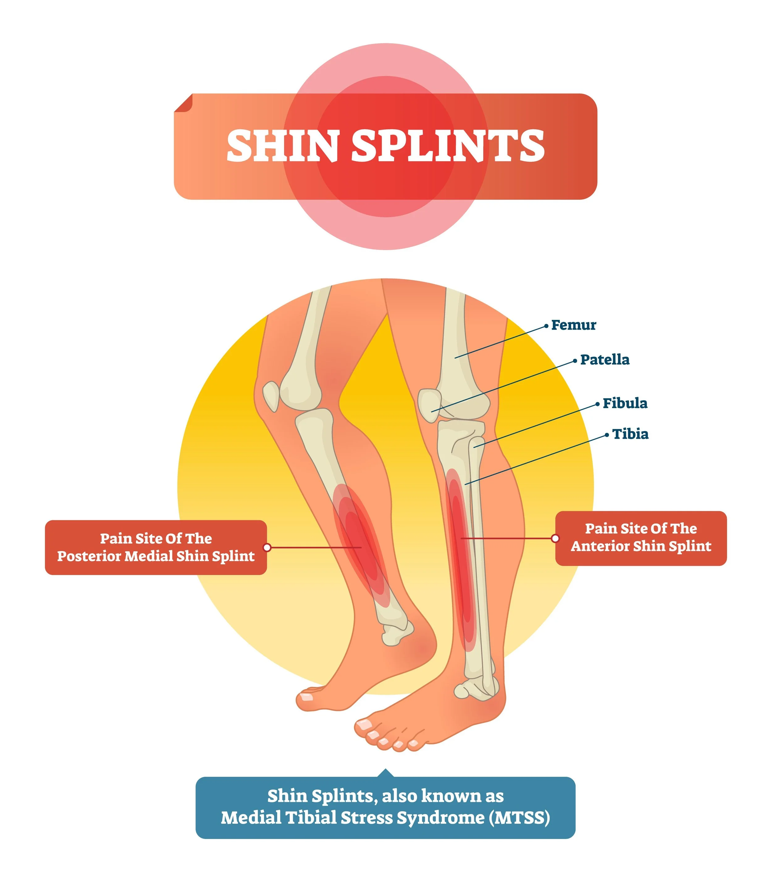 Shin Splints Treatment NYC — Morningside Acupuncture NYC
