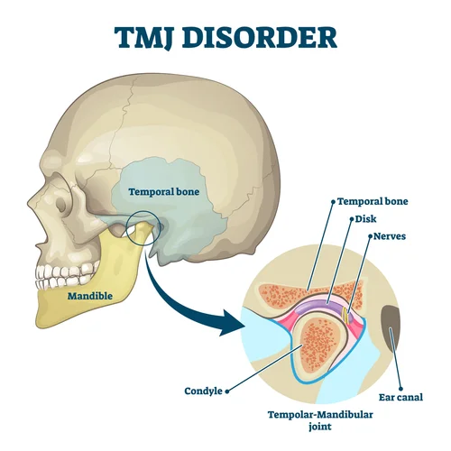 Dry Needling for TMJ — Morningside Acupuncture NYC