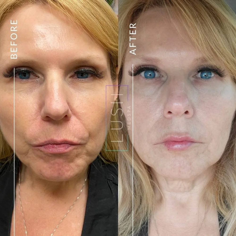 PDO Threads Non-Surgical Facelift | Houston, TX | Lush RX Med Spa