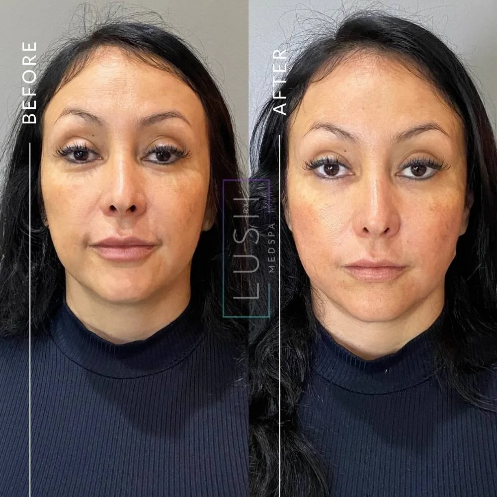 PDO Threads Non-Surgical Facelift | Houston, TX | Lush RX Med Spa