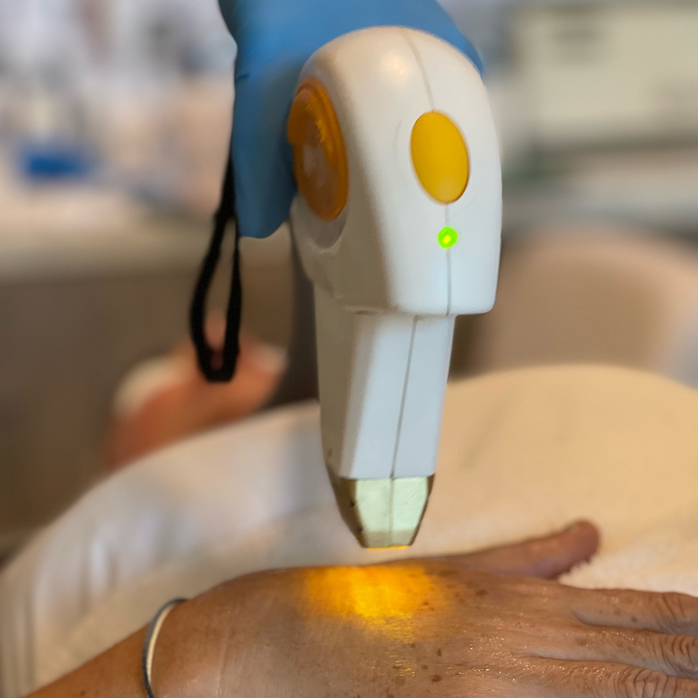 ICON MAXG™ IPL Photofacial Treatment in Miami, FL — Skincare by Amy ...