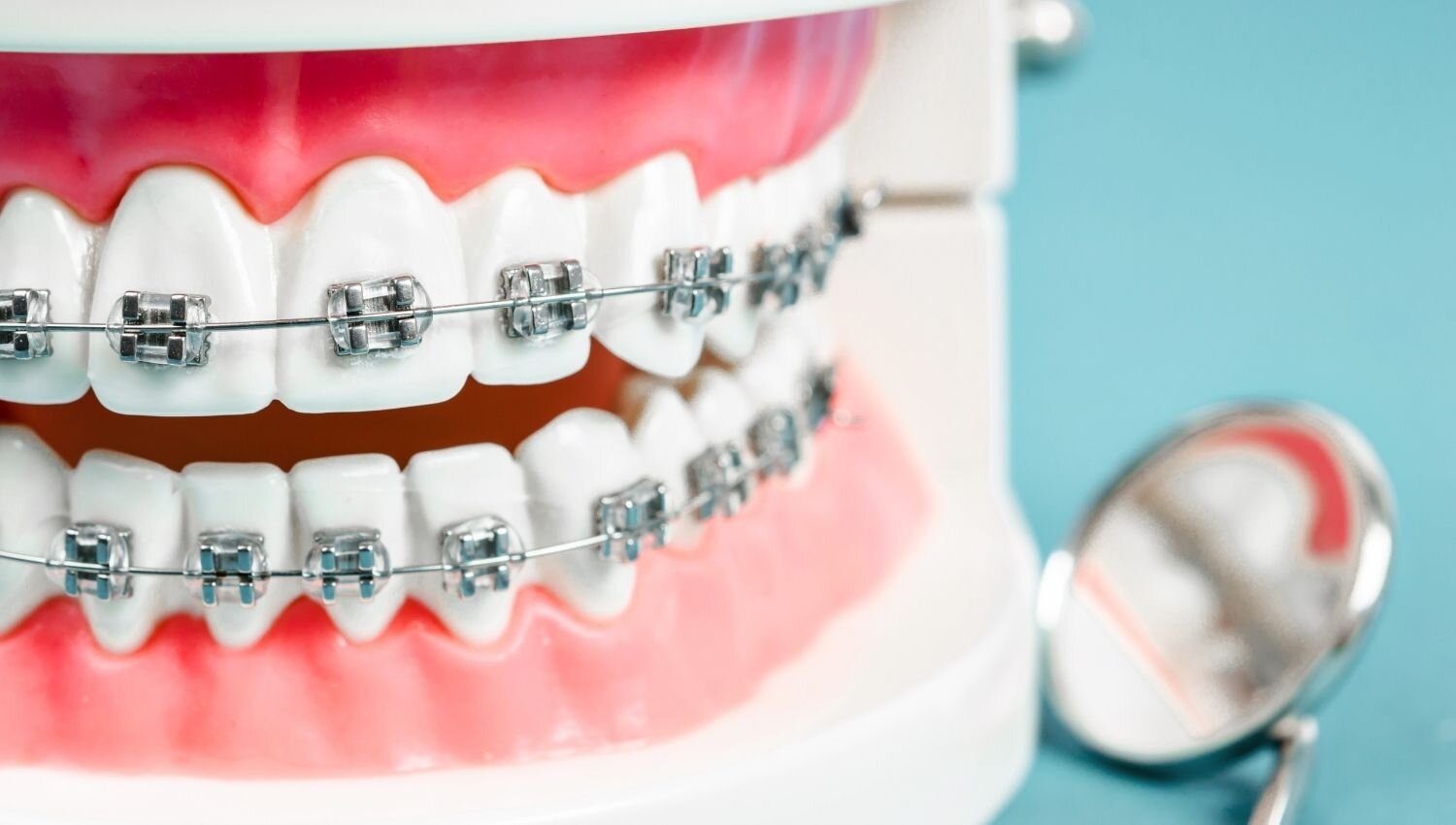 Dental Braces | Get Your Perfect Smile Now — Water Oak Dental