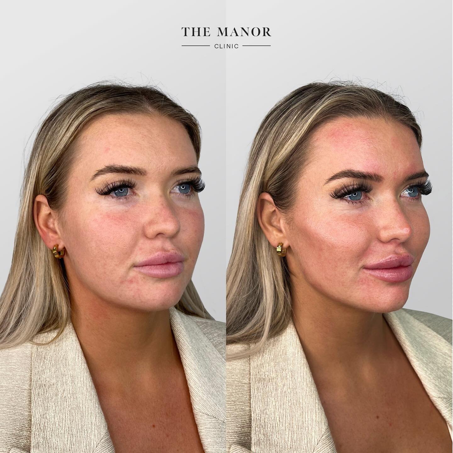 The Manor Clinic | Cosmetic Injectables Brisbane | Dermal Filler & Anti ...