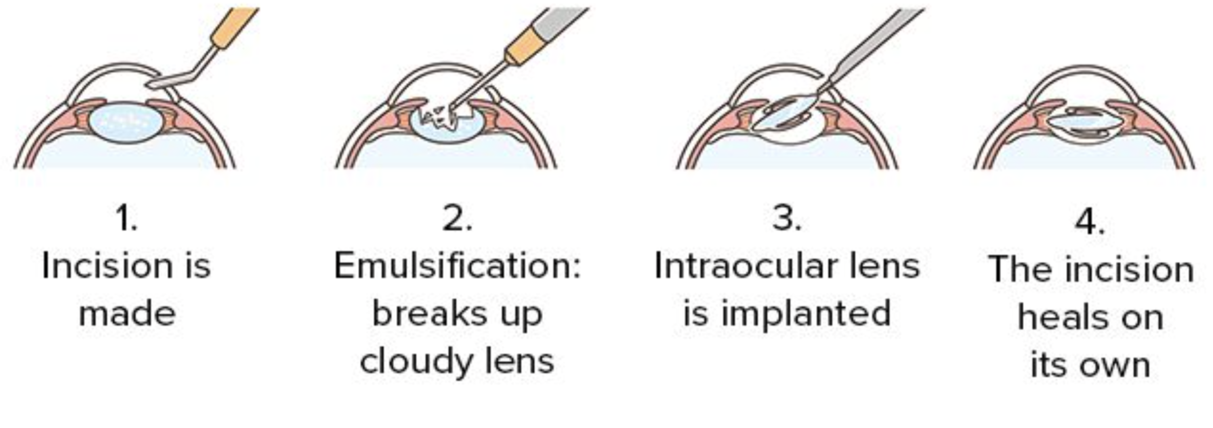 Pasadena Eye Doctor – Focus Eye Center – What is Clear Lens Extraction?