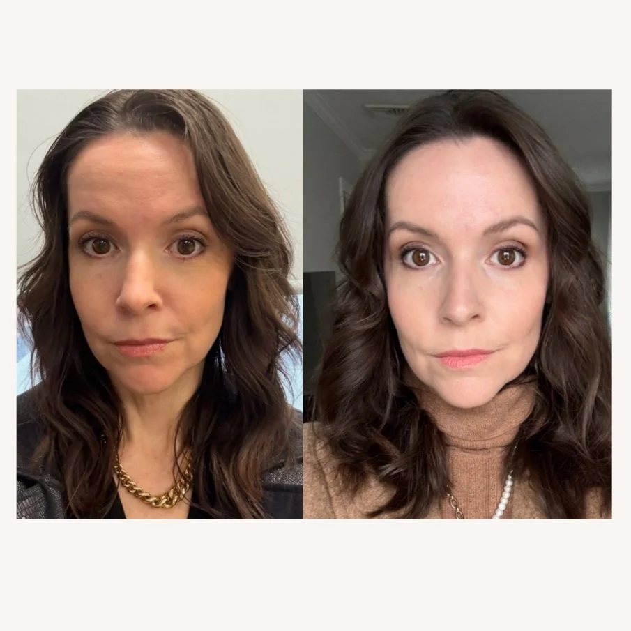 I Tried It: Lower Face Tox — Pretty Local
