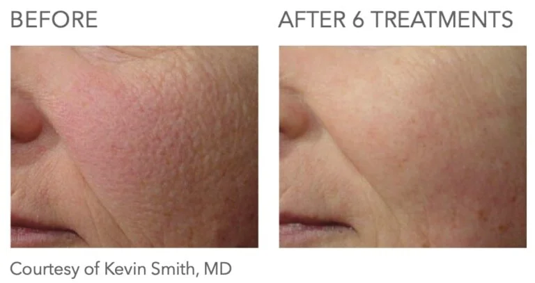 Rosacea & Diffuse Redness — 1192 Laser & Beauty Clinic