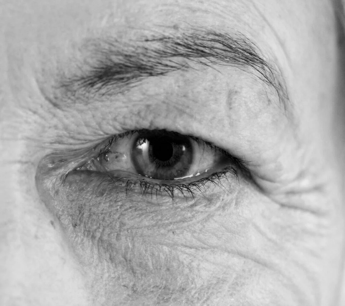 Eyebrow Ptosis Treatment | Eagle & Boise, ID — Aesthetic Eye, P.C.