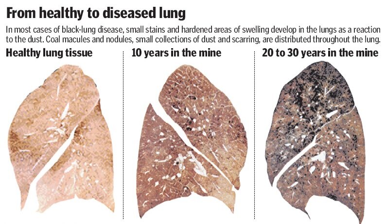 About Black Lung — Lungs At Work