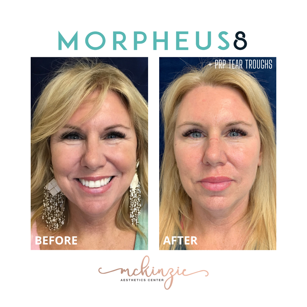 Under-Eye Bags? Why You Should Opt for PRP Injections — McKinzie ...