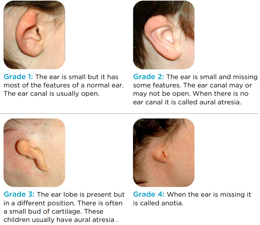 About Microtia Expanded — Craniofacialcare.org