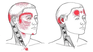 What trigger points are, methods to treat it, and preventing recurrence ...