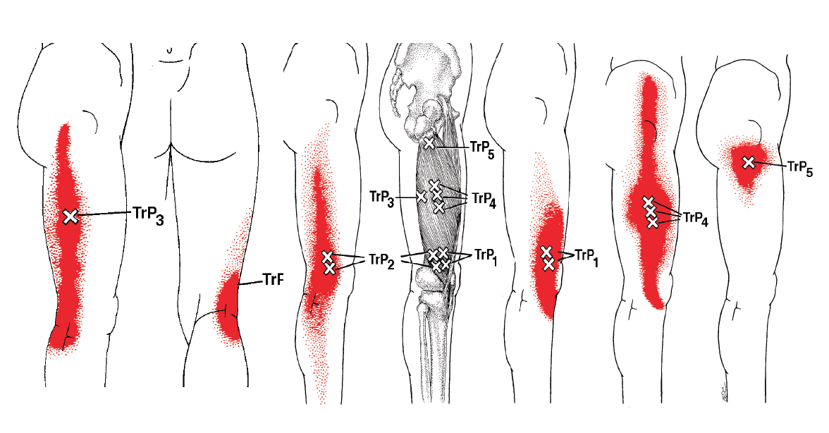 What trigger points are, methods to treat it, and preventing recurrence — CENTRAL PHYSICAL ...