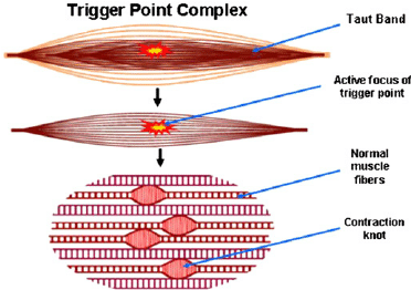 What trigger points are, methods to treat it, and preventing recurrence ...