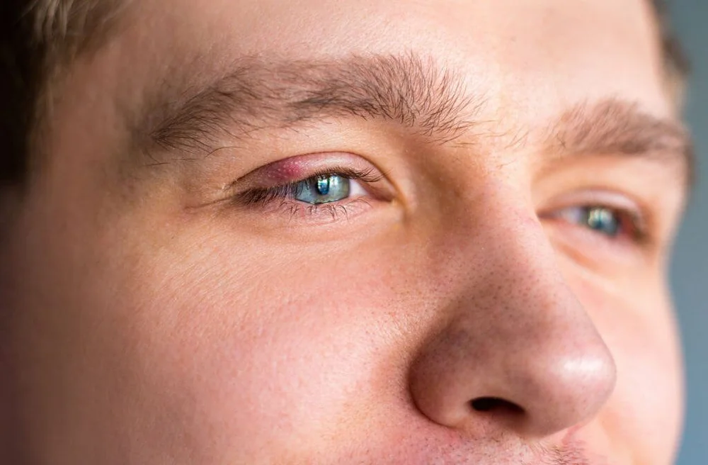 Chalazion vs. Stye: What’s the Difference & Treatment Options ...