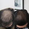 Hair Growth Exosomes - NZ Treatment - The Hair Clinic