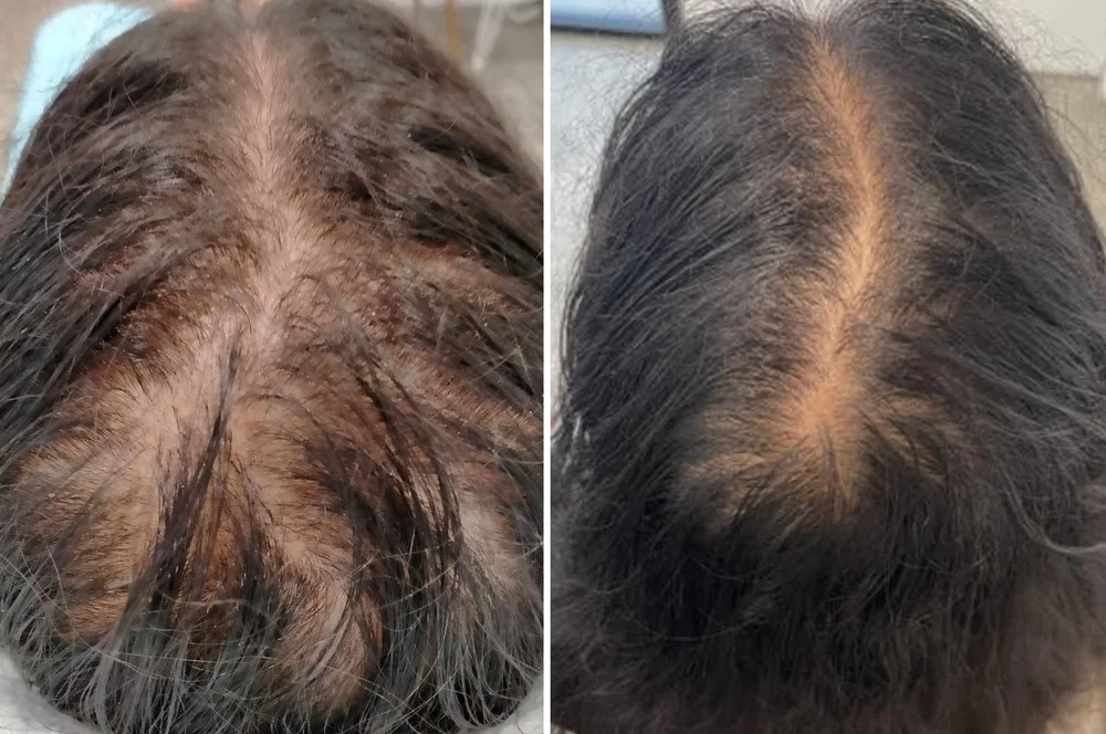 PCOS Related Hair Loss Treatments - The Hair Clinic