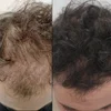 Hair Growth Exosomes - NZ Treatment - The Hair Clinic